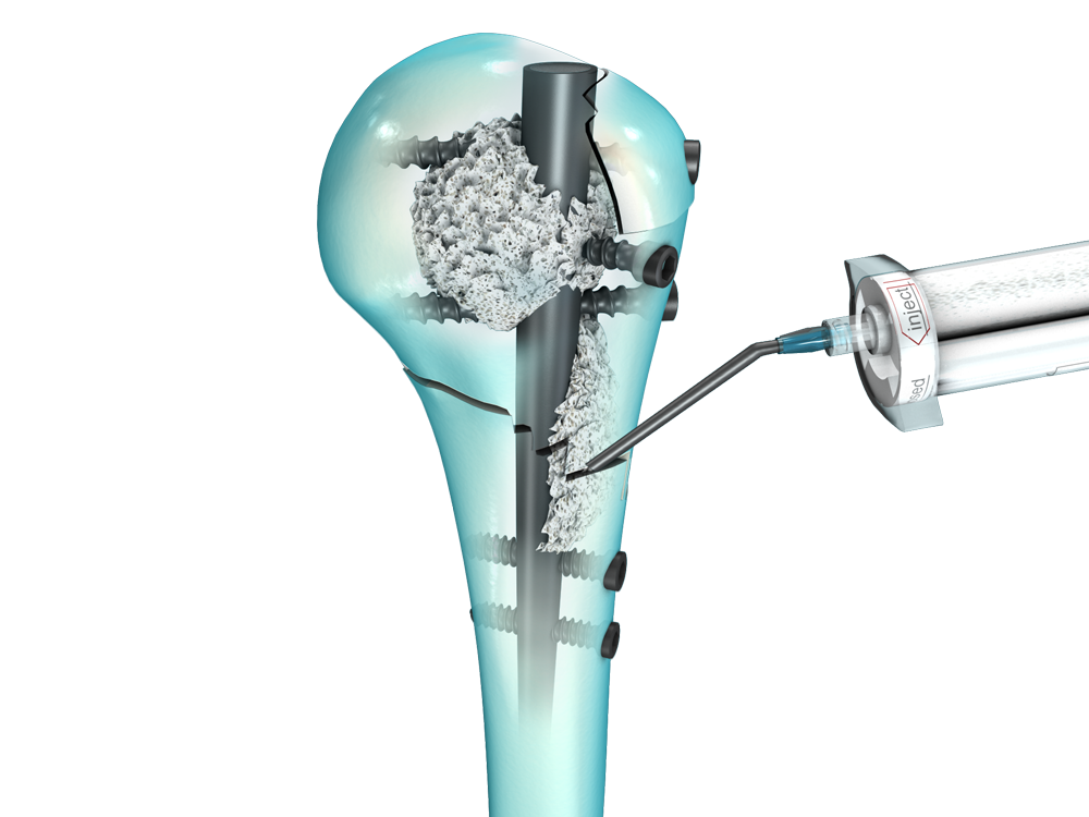 Graftys: Quickset | Evolutis NZ