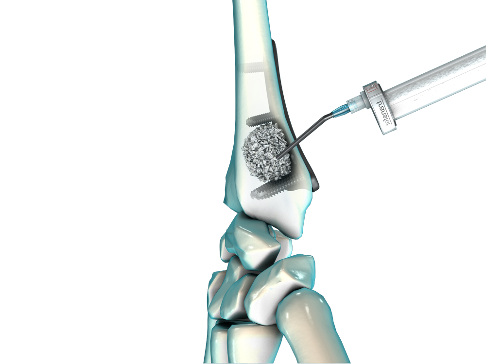 Graftys: Quickset | Evolutis NZ